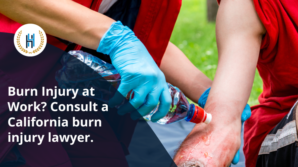Burn Injury at Work? Consult a California burn injury lawyer.